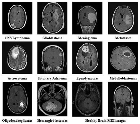 Frontiers An Enhanced Pattern Detection And Segmentation Of Brain Tumors In Mri Images Using