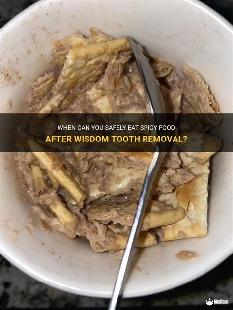 When Can You Safely Eat Spicy Food After Wisdom Tooth Removal Medshun