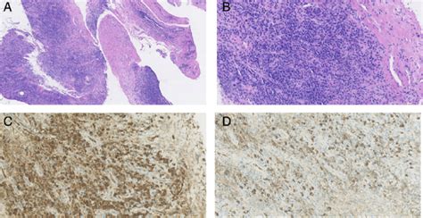Pleural Biopsy With Massive Lymphoplasmacytic Inflammation A Download Scientific Diagram