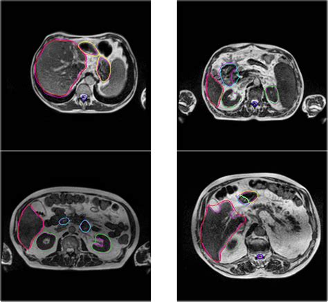 Frontiers Deep Learning Application For Abdominal Organs Segmentation On 035 T Mr Linac Images