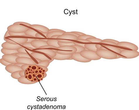 Serous Cystadenoma Pancreas