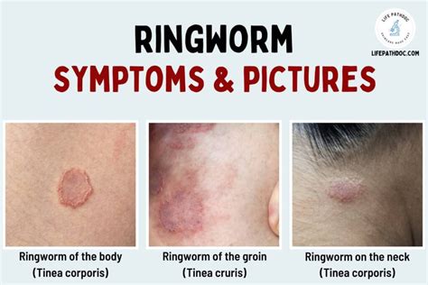 Ringworm Signs Symptoms And Complications Bilarasa