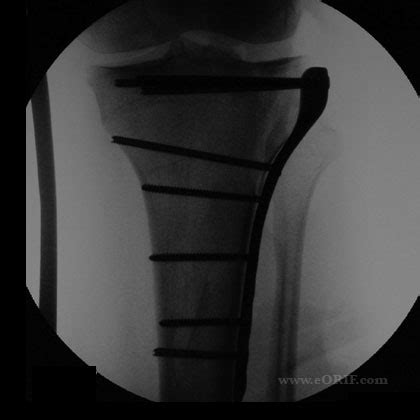 Tibial Plateau Fracture ORIF EORIF