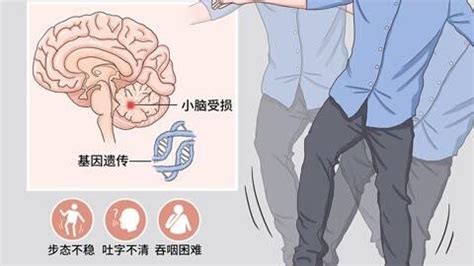 揭秘小脑萎缩共济失调患者能活多久 哔哩哔哩