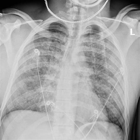 Chest X Ray On Day One With Diffuse Bilateral Infiltrates Download Scientific Diagram