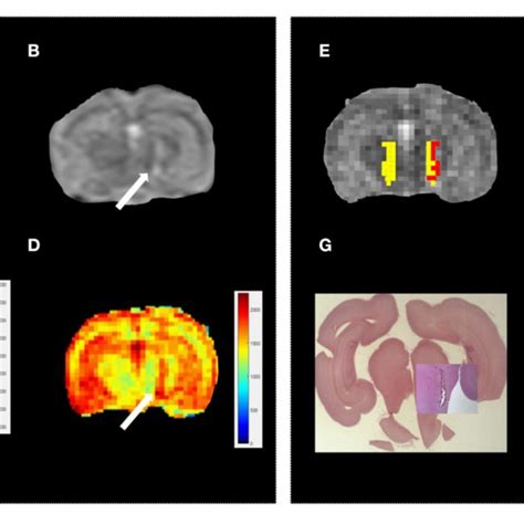Standard Vs Mrr Analyses And Histopathological Validation Example