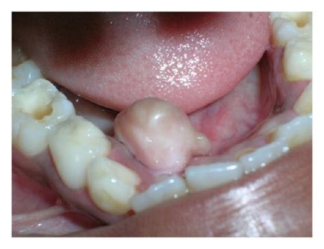 Giant Cell Fibroma In A Paediatric Patient A Rare Case Report Reddy