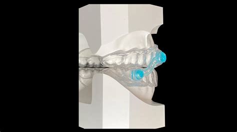 Silensor Sl Prodirect Dental Laboratory