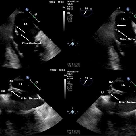 Tee Imaging Of The Left Atrium Showing The Absence Of The Chiari