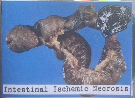 Bowel Necrosis Intestinal Ischemic Necrosis Cdr Business Card