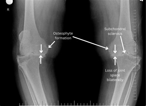Common Musculoskeletal X Ray Findings In Osces Geeky Medics