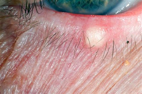 Chalazion Cyst On An Eyelid Stock Image C0472922 Scie