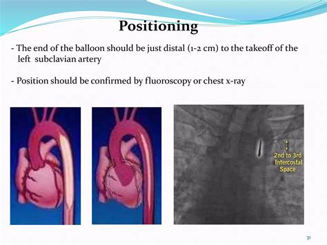 Iabp Instrumentation Indications And Complications Ppt