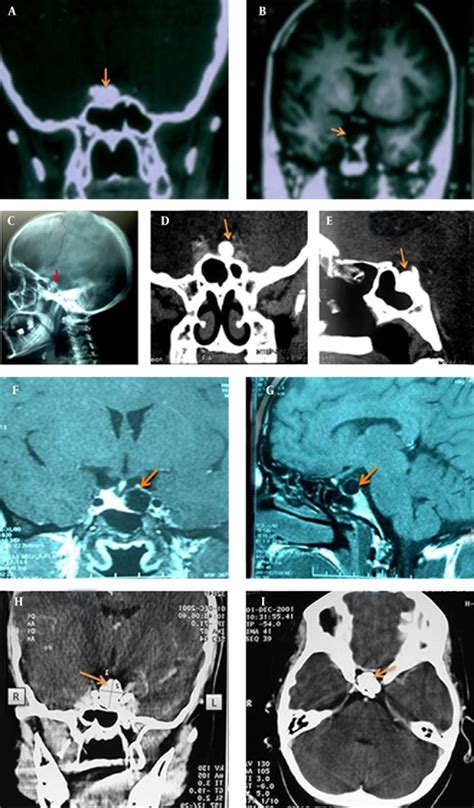 Computed Tomographic Scan And Magnetic Resonance Imaging Of Pituitary