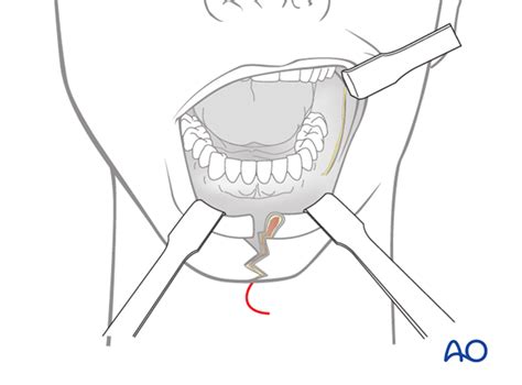Lip Split Approach To The Mandible
