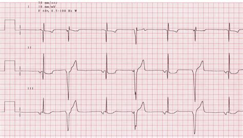 The Approach To Abnormal Cardiac Rhythm Vetscentral Library