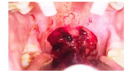Post Tonsillectomy Bleeding Pptx