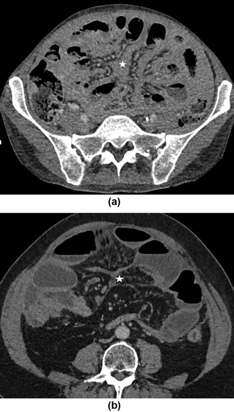 “pause” A Method For Communicating Radiological Extent Of Peritoneal