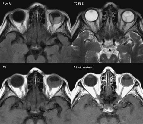 Retinoblastoma Differential Diagnosis Wikidoc