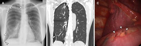 Pictorial Review Of Pleural Disease Multimodality Imaging And