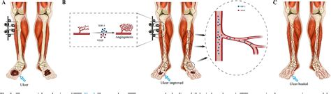 Figure 1 From Efficacy And Safety Of Unilateral Tibial Cortex Transverse Transport On Bilateral