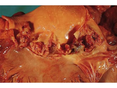 Bacterial Endocarditis 11 Flashcards Quizlet