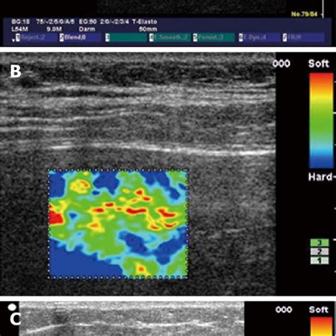 Transient Elastography Fibroscan ® A For The Evaluation Of Normal Download Scientific