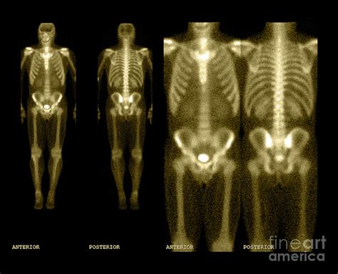 Bone Scan Photograph By Medical Body Scans