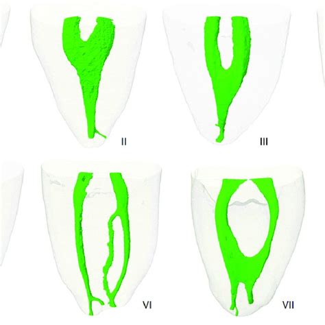 Root Canal Configuration Classified By Applying Vertuccis Criteria