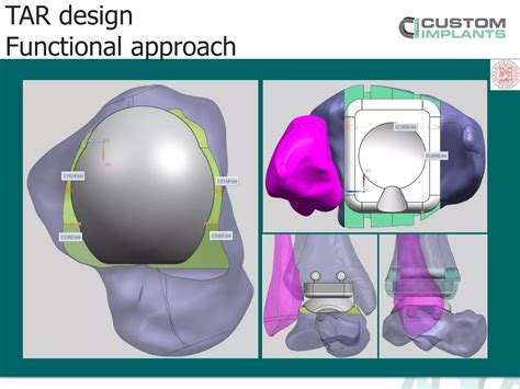 Custom Endoprotesi Design Of Patient Specific Ankle Prosthesis For