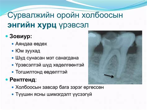 Сүүн шүдний сурвалжийн оройн холбоосын үрэвслийн шалтгаан Pptx