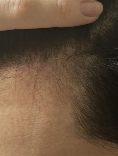 Topical Finasteride For Diffuse Thinning Rtressless