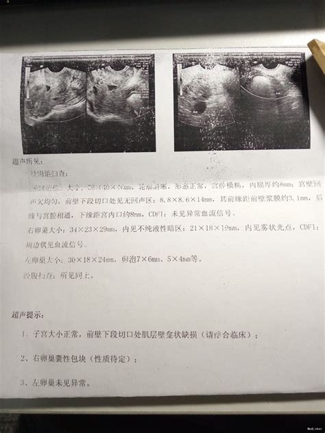 子宫疤痕憩室1例 医联