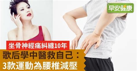 坐骨神經痛糾纏10年歌后學中醫救自己3款運動為腰椎減壓