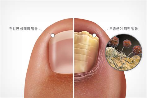발톱 무좀과 레이저 치료