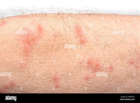Skin Disease Rash On A Man Arm Stock Photo Alamy
