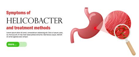 위염과 헬리코박터 파일로리 웹 배너 템플릿입니다 의료 벡터 일러스트 레이 션 만화 스타일 가리기에 대한 스톡 벡터 아트 및 기타