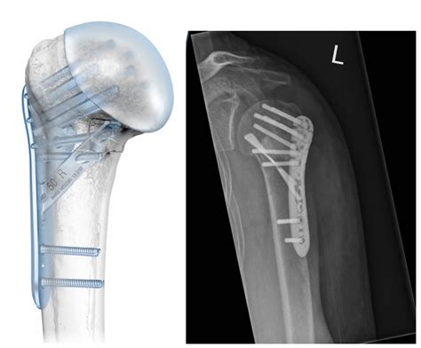 Proximal Humerus Fractures Dr Jeevaka Jay Amaranath Orthopaedic Upper Limb Surgeon