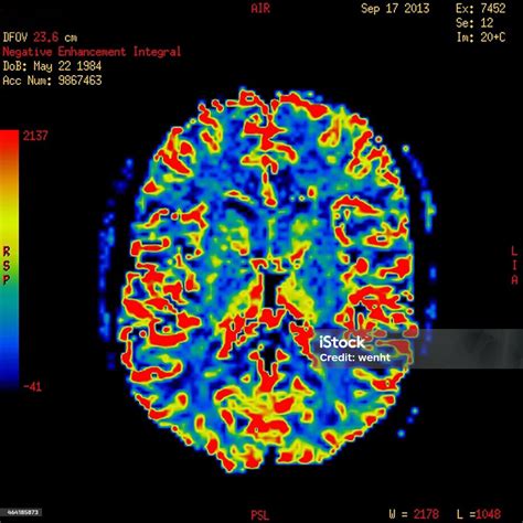 Perfusion Mr Imaging Of A Normal Brain 照片檔及更多 腦 照片 腦 磁力共振掃描 神經科學 Istock
