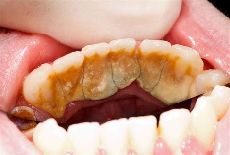 What Are Dental Plaque At Gayla Wilson Blog
