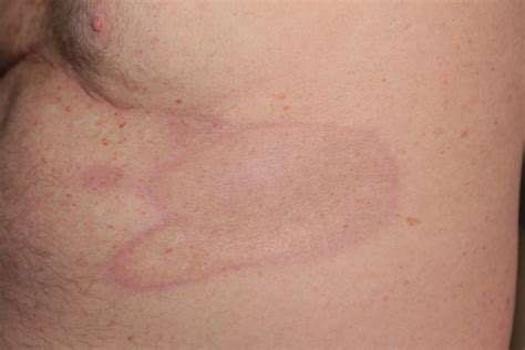 Morphea Skin Morphea Scleroderma Causes And Treatment