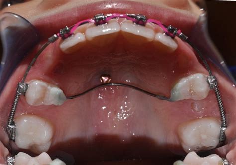 Temporary Anchorage Device Randall Orthodontics