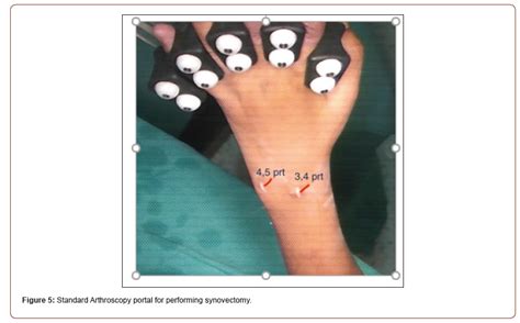 Chronic Synovitis Of Wrist A Diagnostic Dilemma And Role Of Arthroscopy Iris Publishers