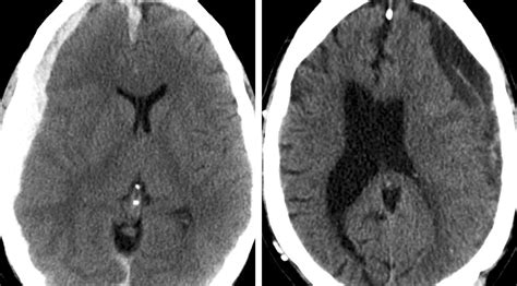 Chronicsubacute Subdural Hematoma The Neurosurgical Atlas