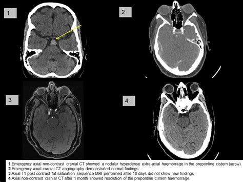 Perimesencephalic Cistern