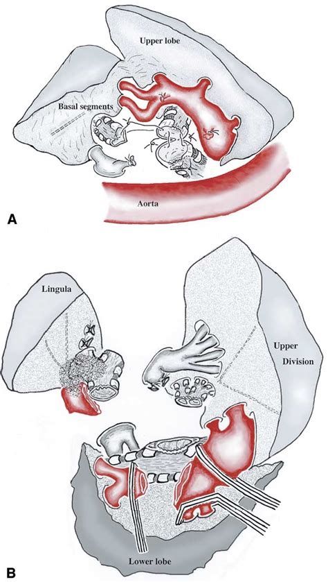 [pdf] Sleeve Segmentectomy For Non Small Cell Lung Carcinoma