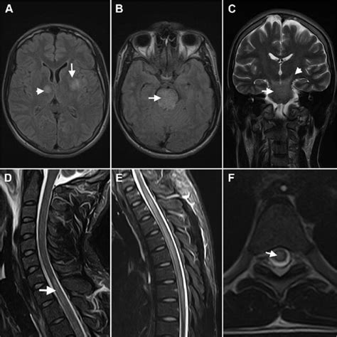 Brain Mri A Axial Flair Showing Hyperintensities In The Right Internal Download Scientific
