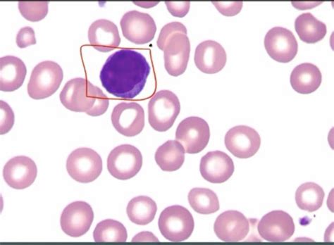 Microcytic Anemia Flashcards Quizlet