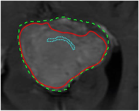 Brain Tumor With A Original Image B User Initialization C And
