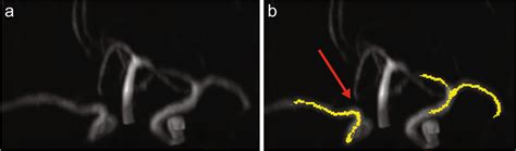 Successful Detection Of Aplastic A1 Segment A Original Image With Download Scientific